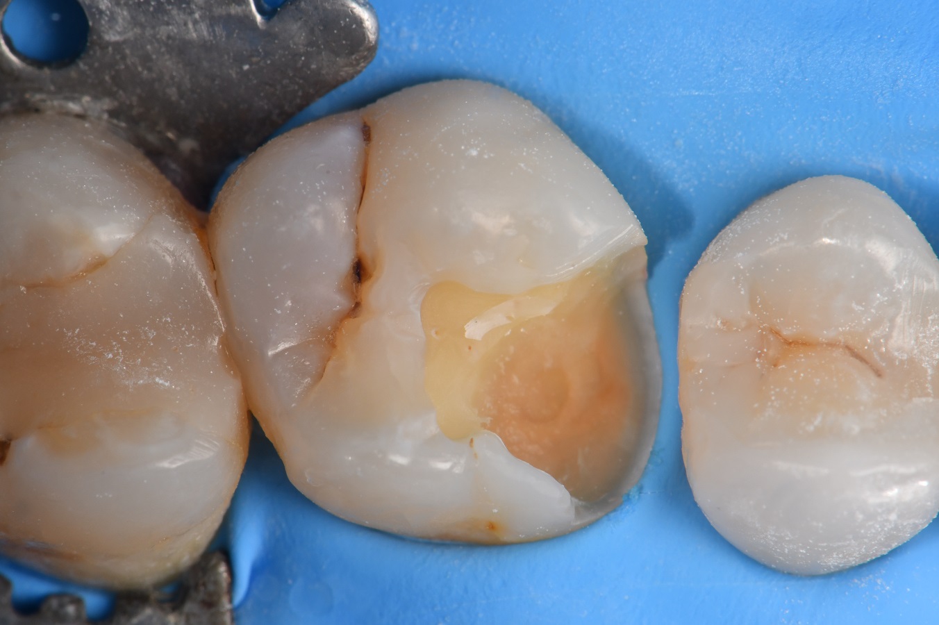 Biomimetic Reconstruction of a broken down tooth