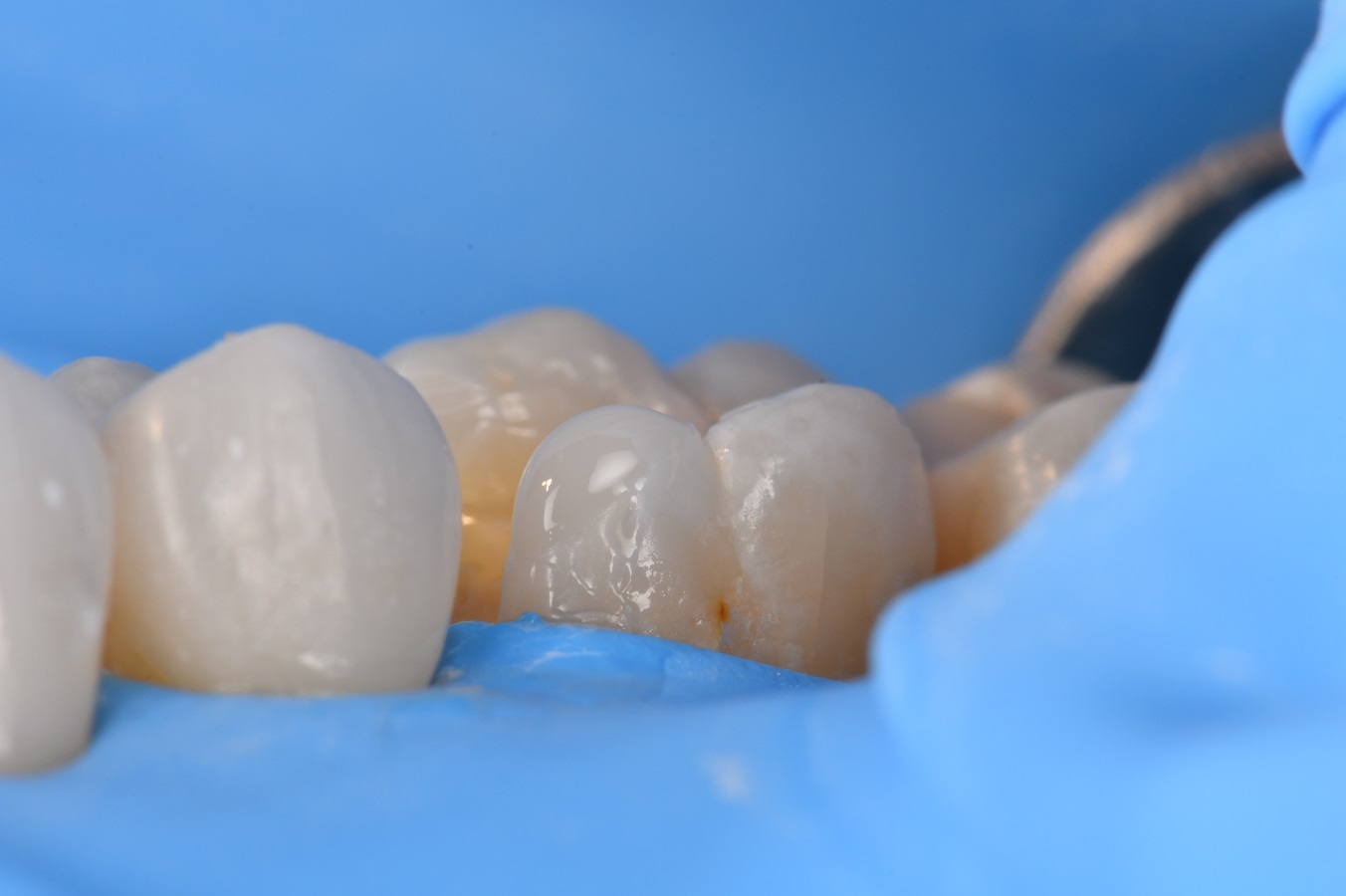 Biomimetic Reconstruction of a broken down tooth