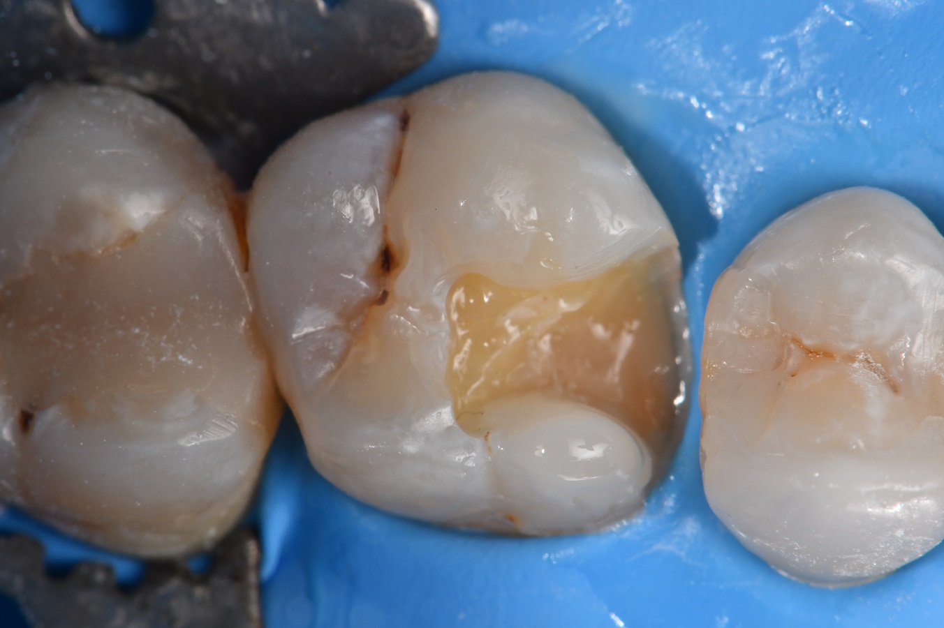Biomimetic Reconstruction of a broken down tooth