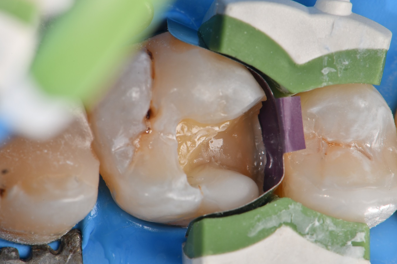 Biomimetic Reconstruction of a broken down tooth