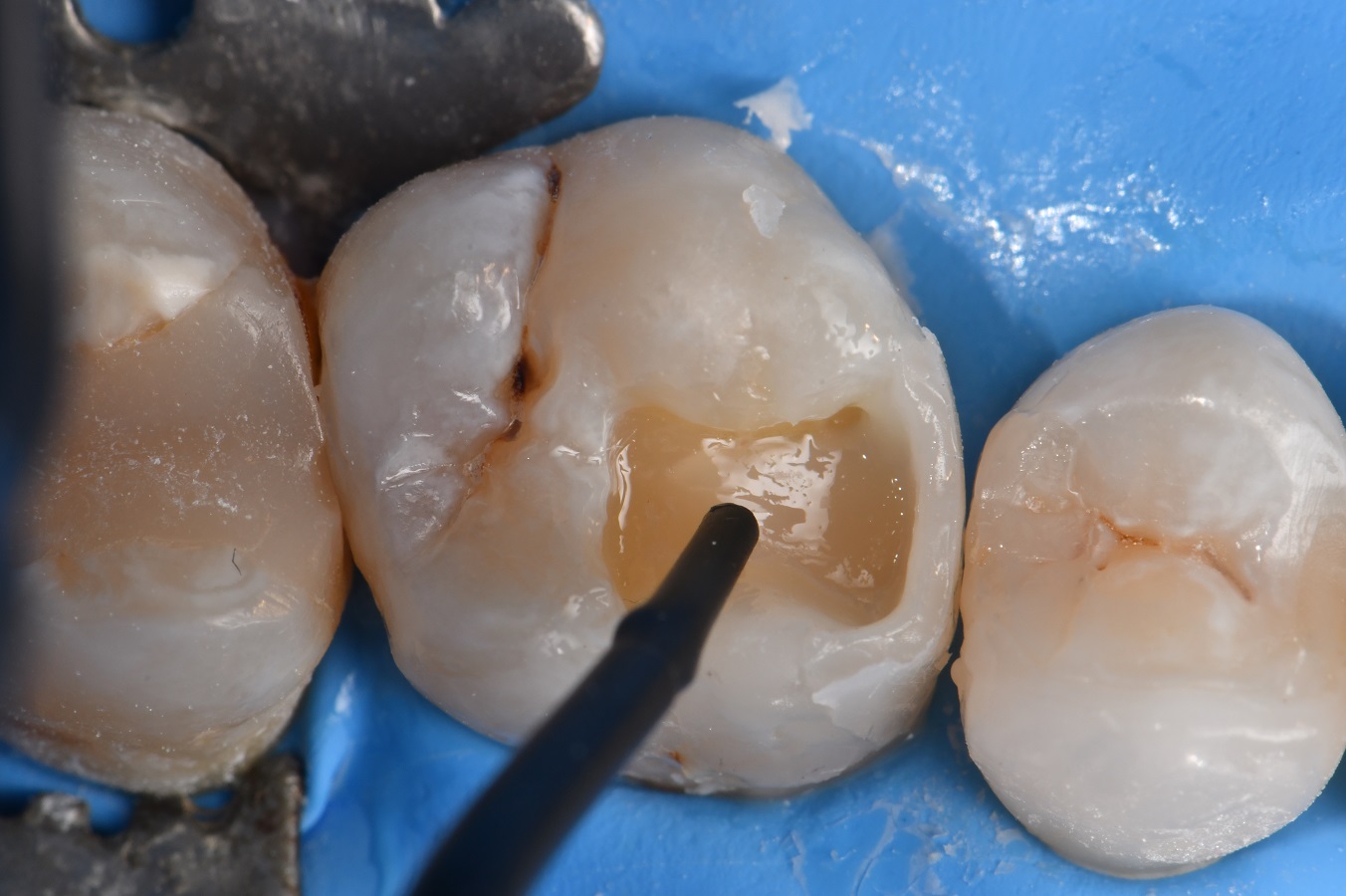 Biomimetic Reconstruction of a broken down tooth