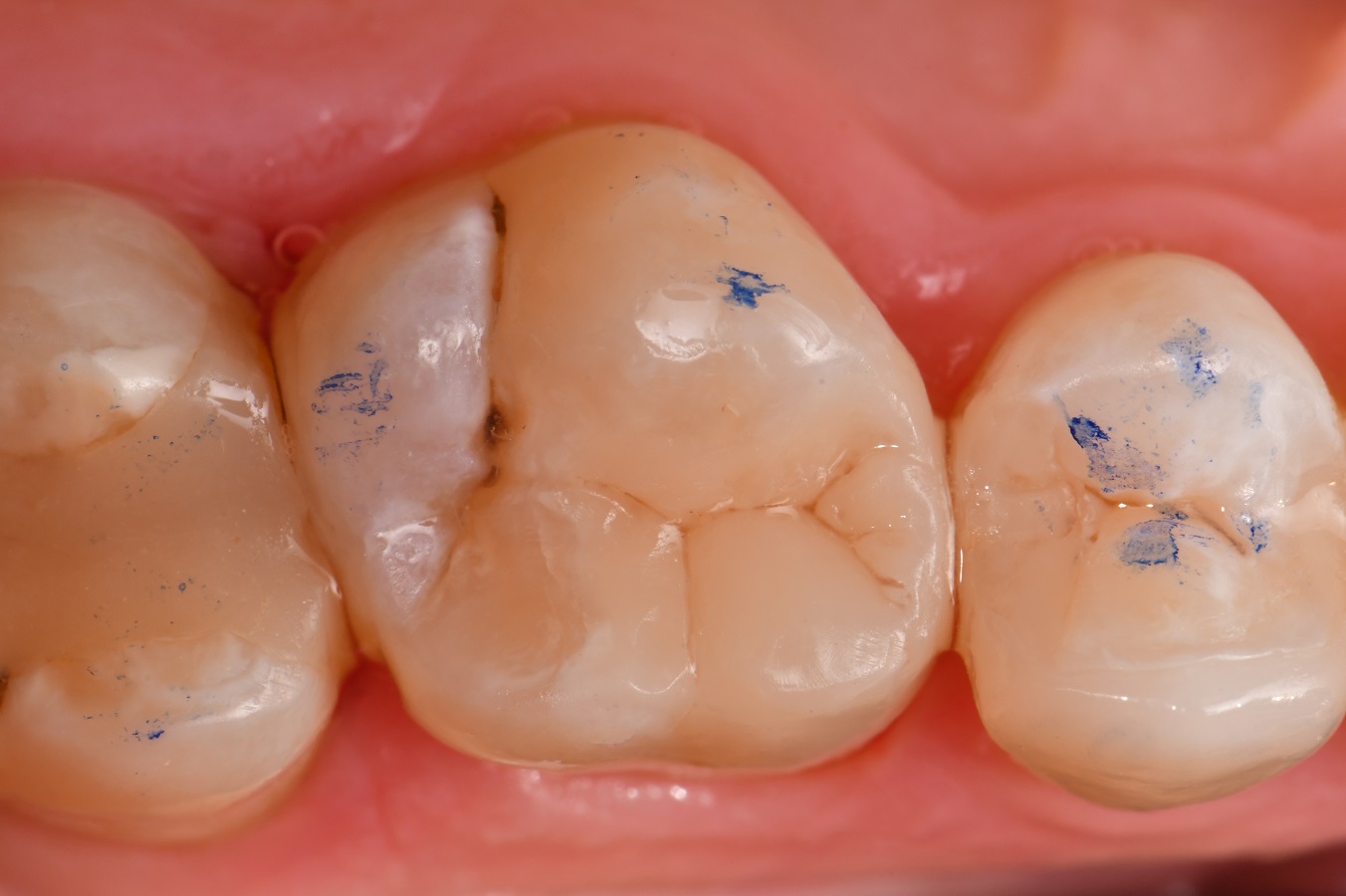Biomimetic Reconstruction of a broken down tooth