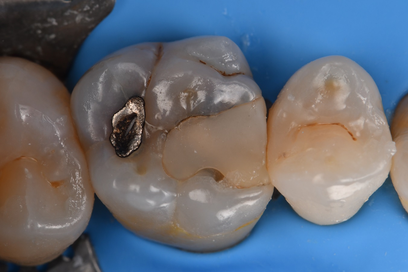 Designing Anatomy for a heavily restored molar in composite resin