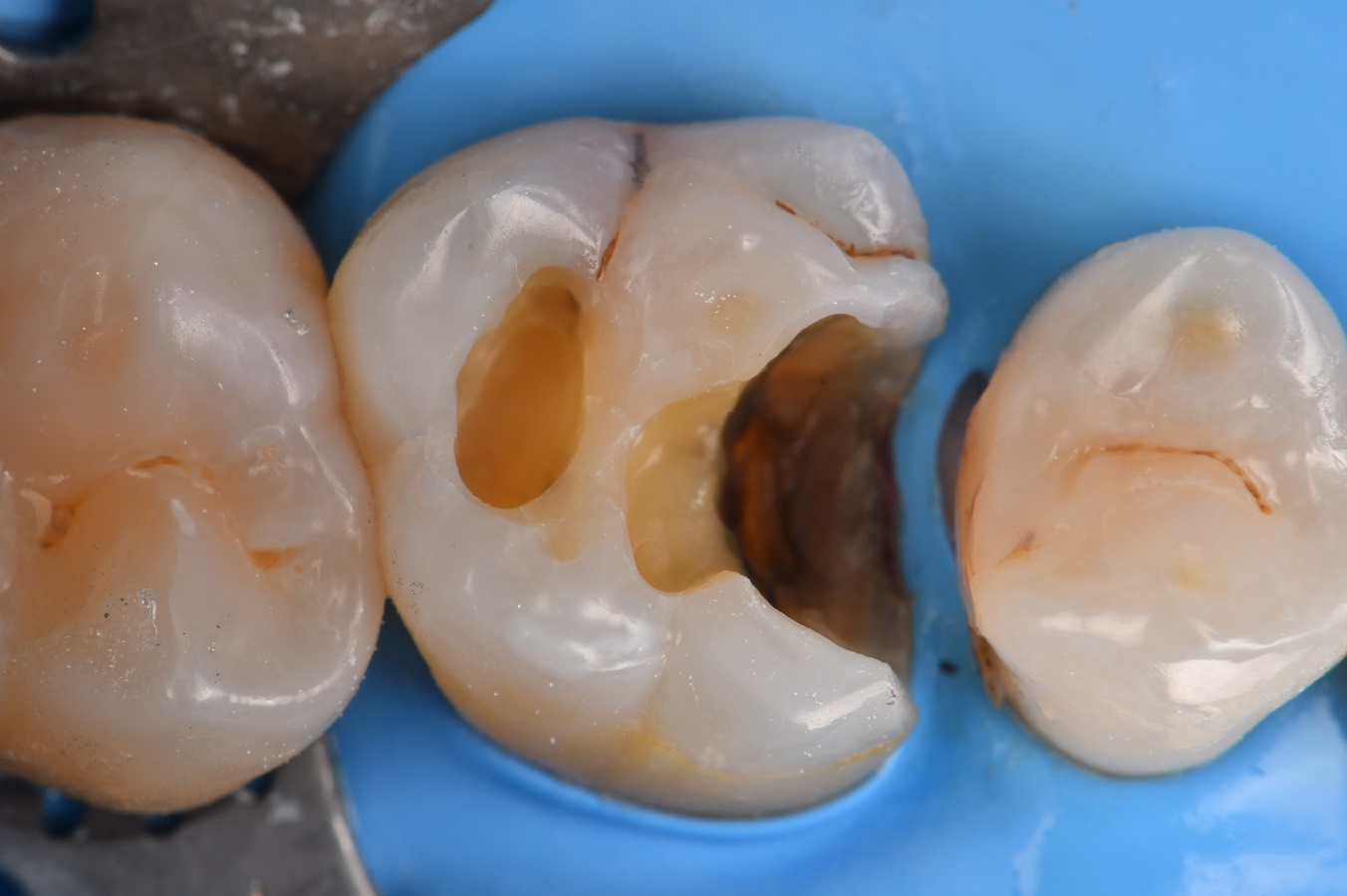 Designing Anatomy for a heavily restored molar in composite resin