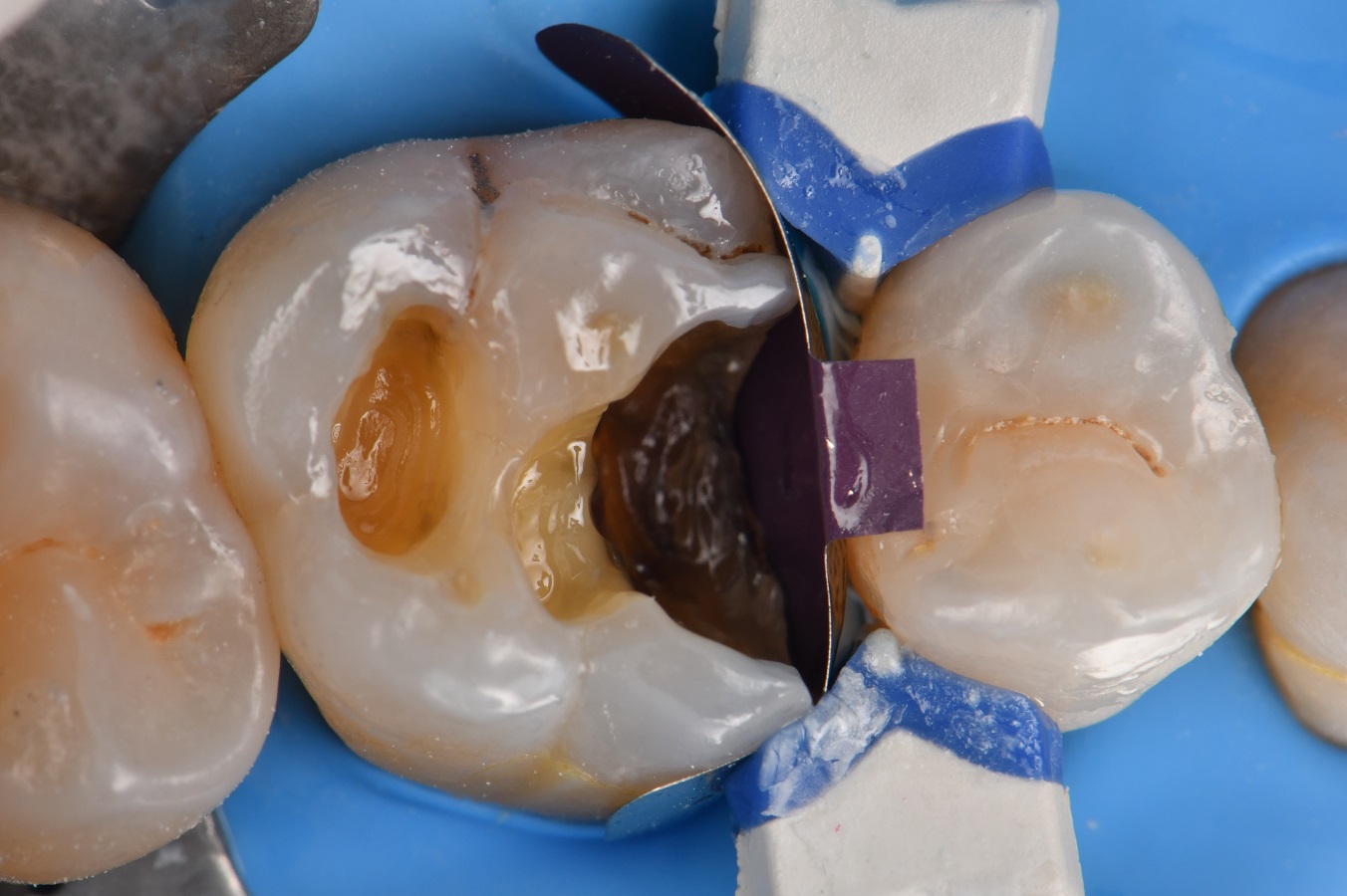 Designing Anatomy for a heavily restored molar in composite resin