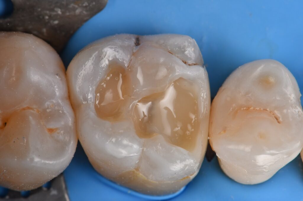 Designing Anatomy for a heavily restored molar in composite resin