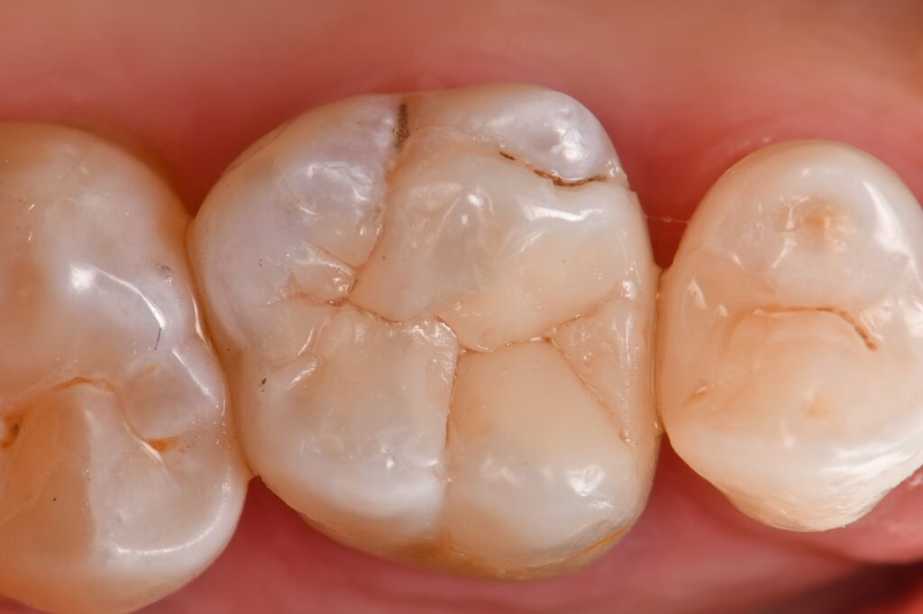 Designing Anatomy for a heavily restored molar in composite resin