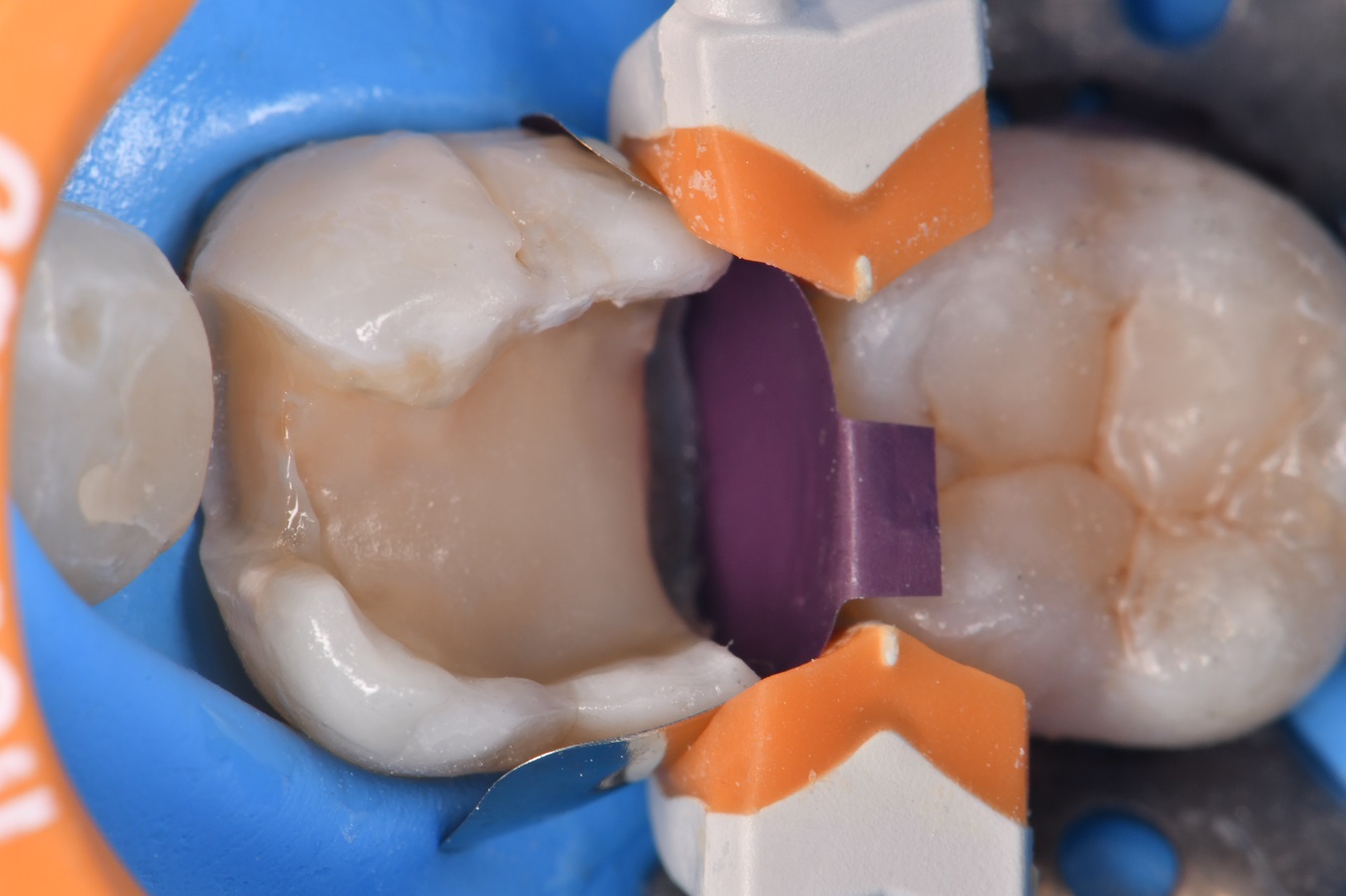 Variant anatomy on a first molar with composite