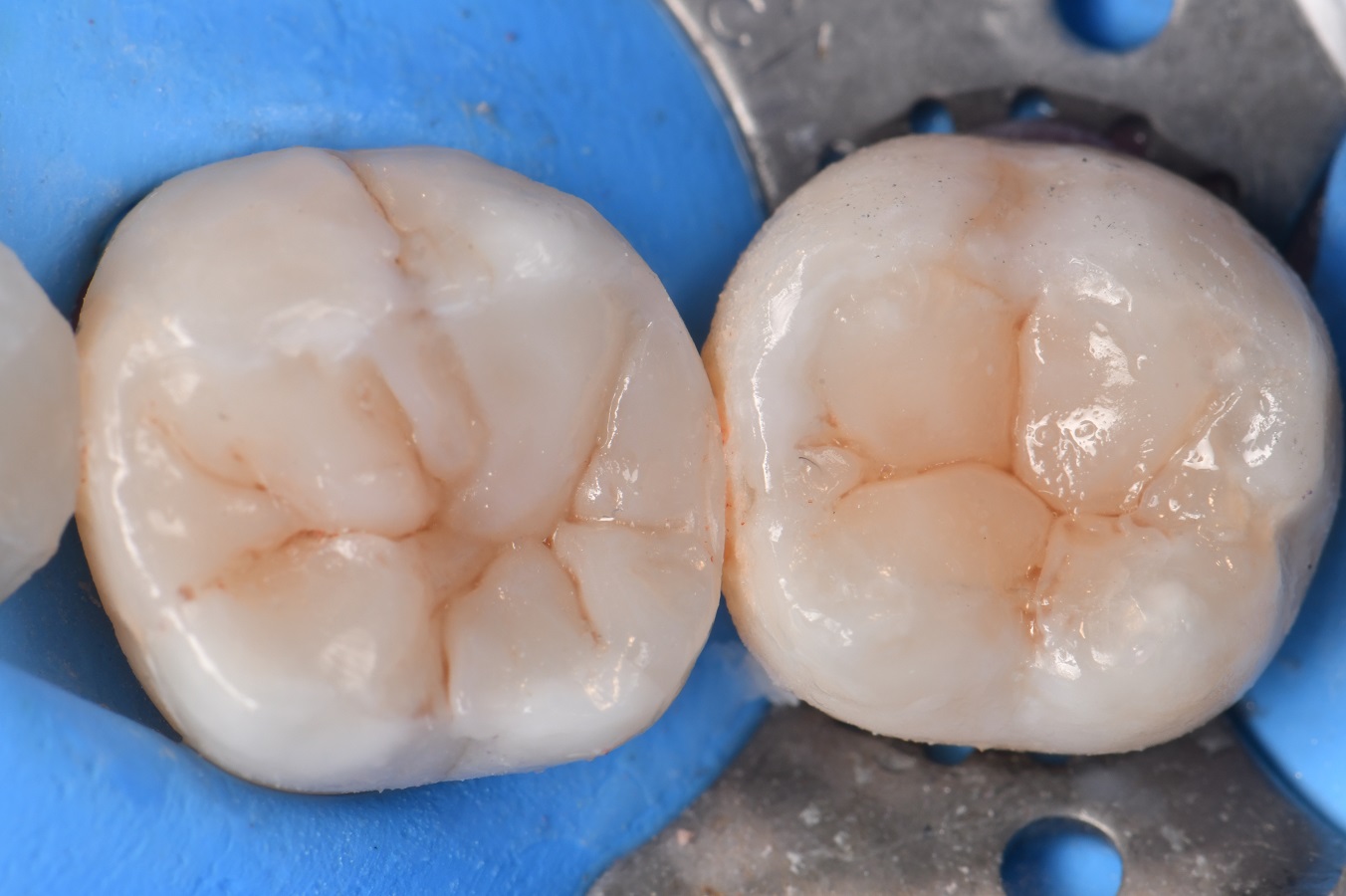 Variant anatomy on a first molar with composite