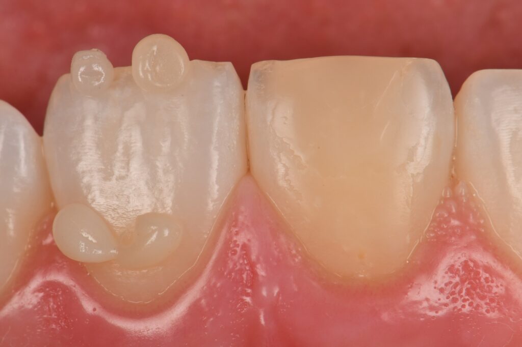 Dehydration and Rehydration Effects in a Composite Veneer case