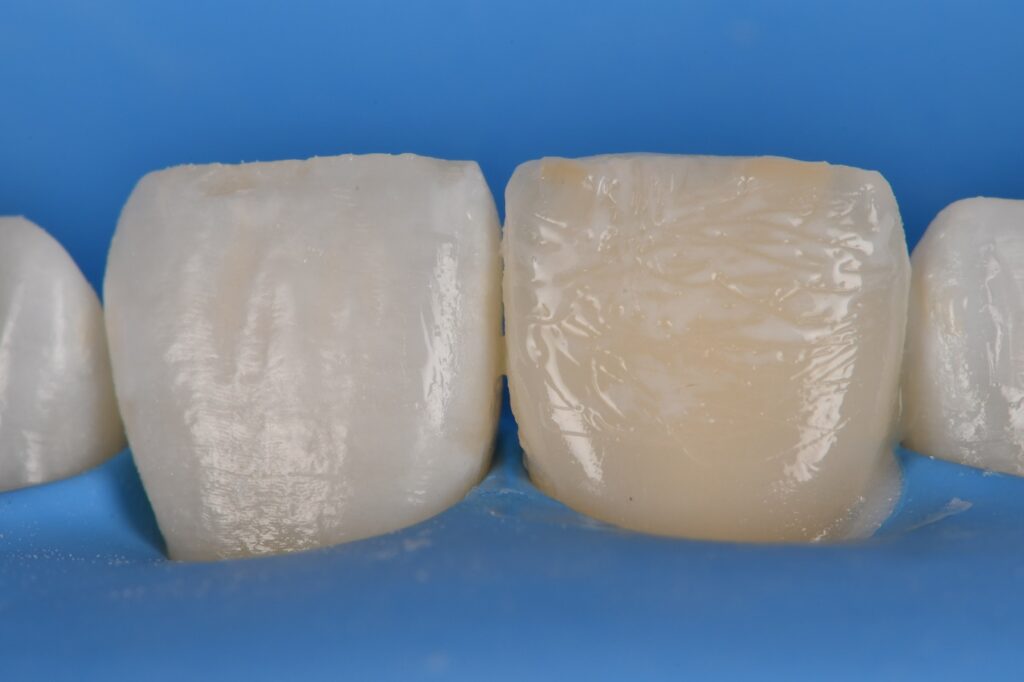 Dehydration and Rehydration Effects in a Composite Veneer case