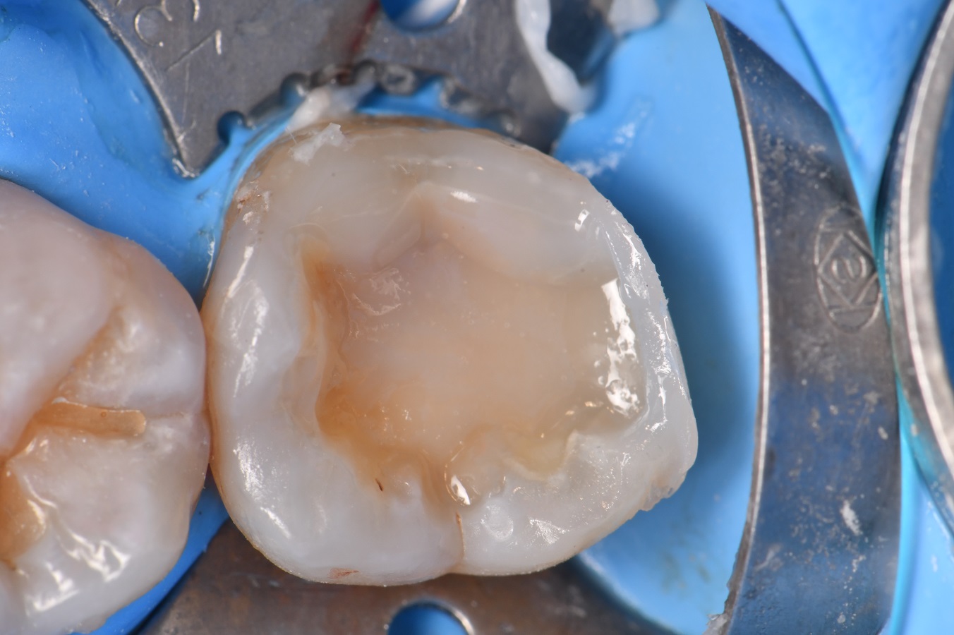 Clearfil Majesty ES2 Universal Matrix in Matrix technique