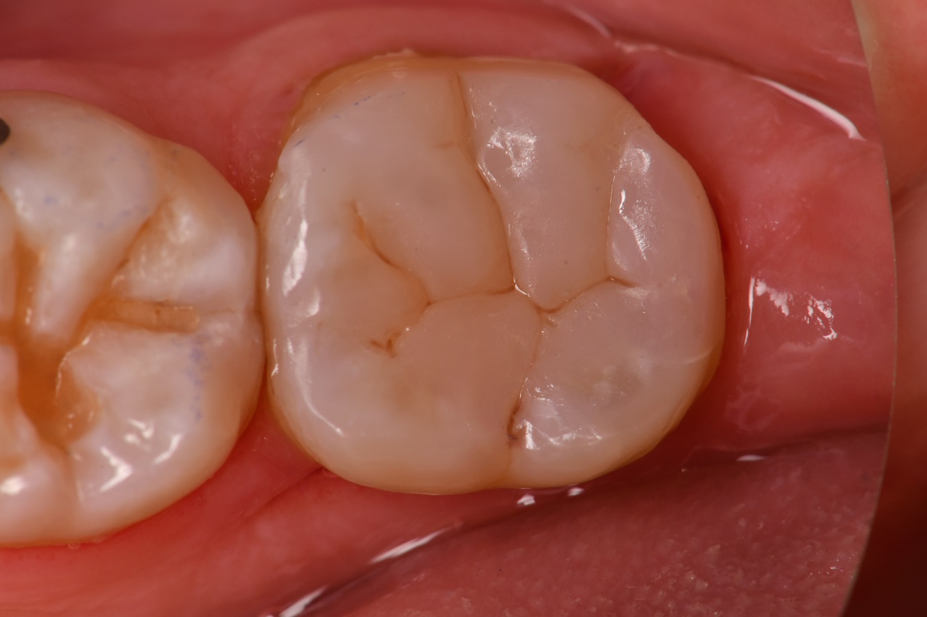 Clearfil Majesty ES2 Universal Matrix in Matrix technique