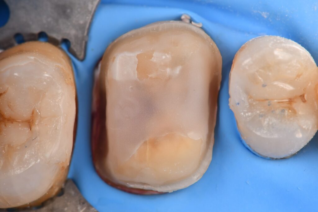 Isolation for a deep carious margin