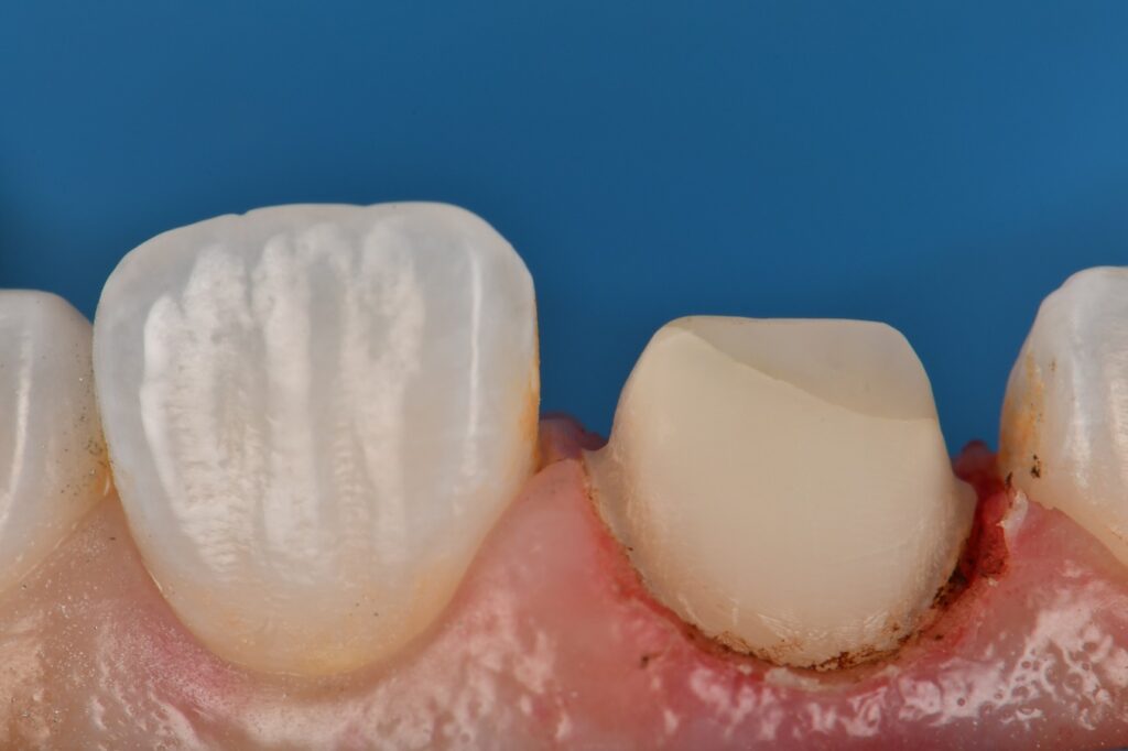 Provisionals are the key to Prosthodontic Predictability
