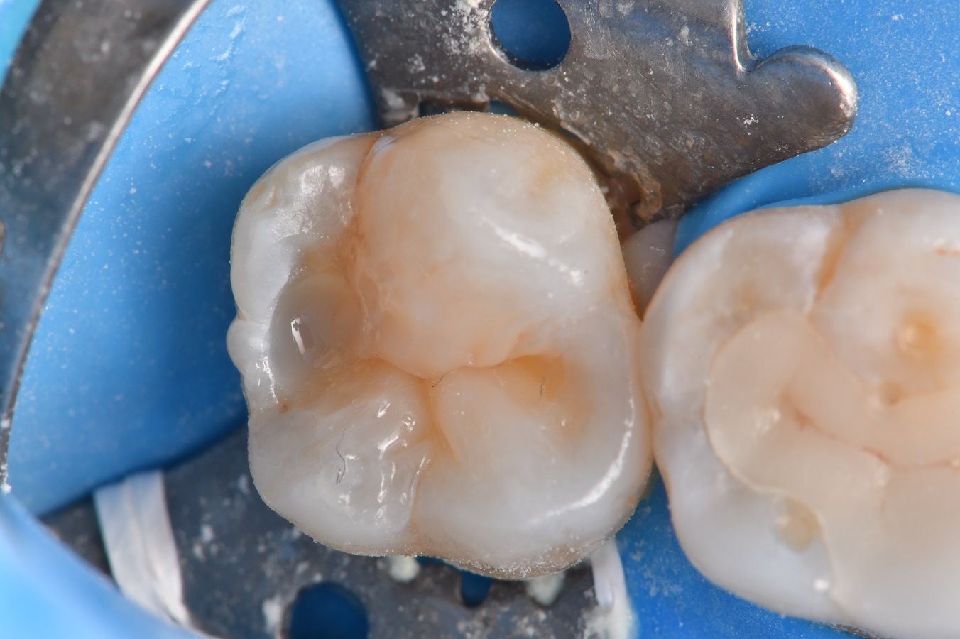 Partial Dental Composite Restoration Replacement Workflow