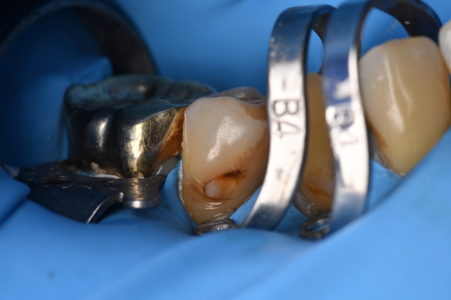 Class V restorations under rubber dam with primary and secondary clamps