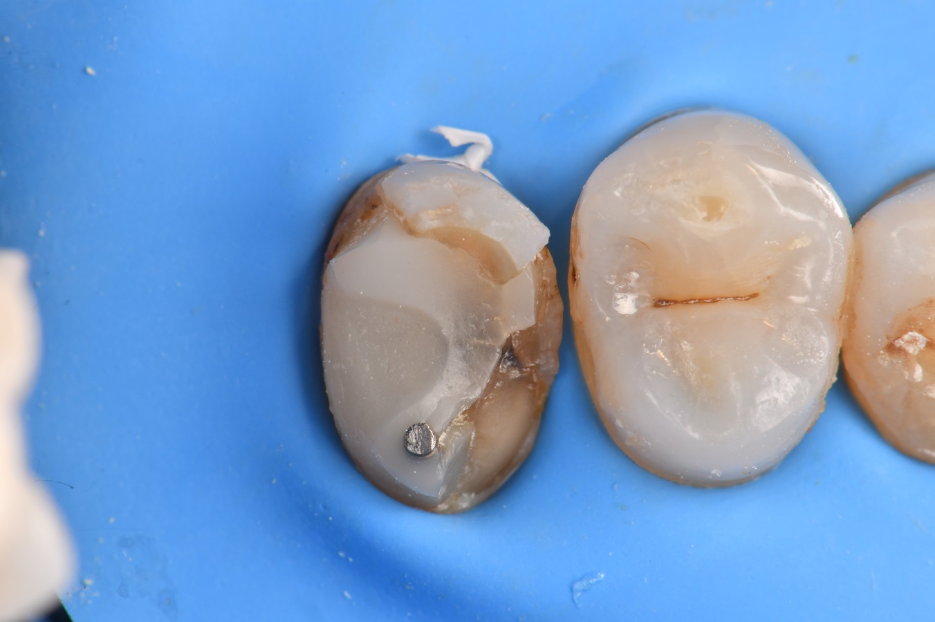 Direct Complex Crown reconstruction in composite resin