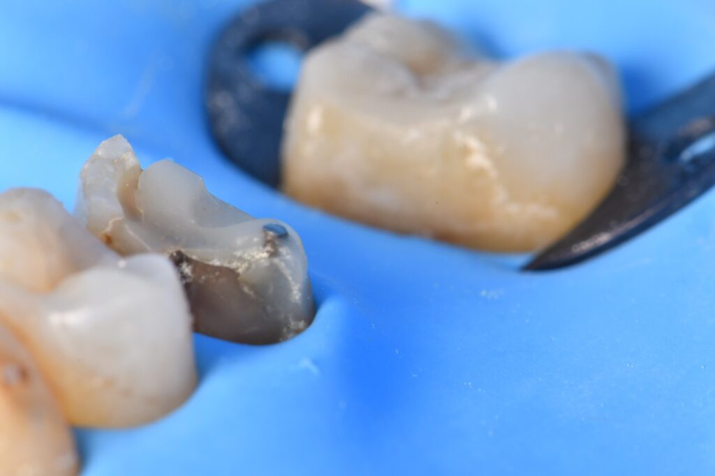 Direct Complex Crown reconstruction in composite resin