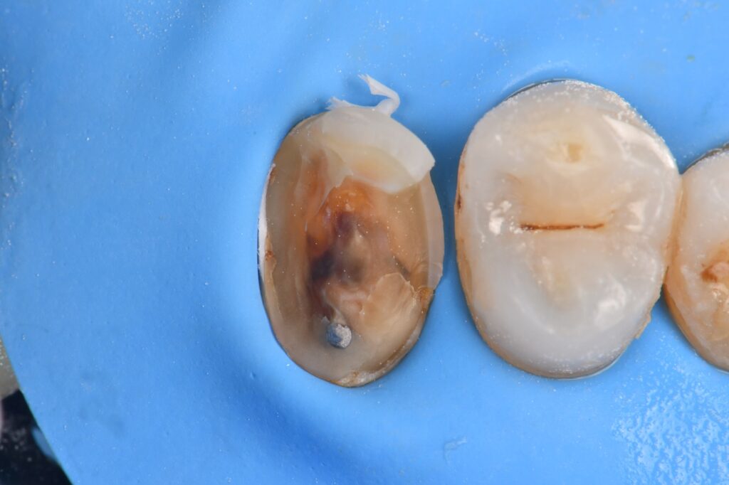 Direct Complex Crown reconstruction in composite resin