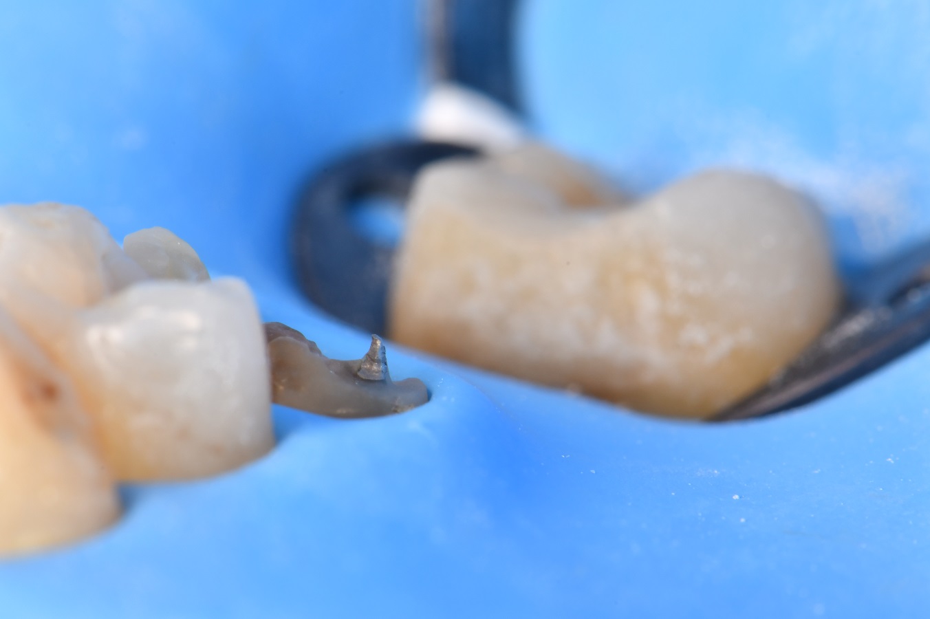 Direct Complex Crown reconstruction in composite resin