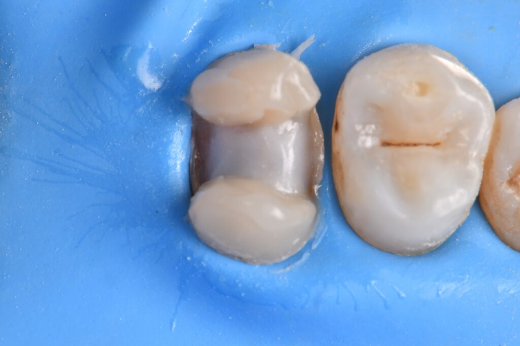 Direct Complex Crown reconstruction in composite resin