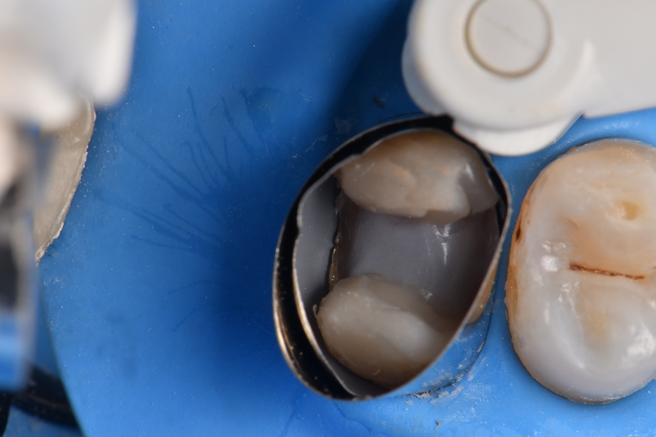 Direct Complex Crown reconstruction in composite resin