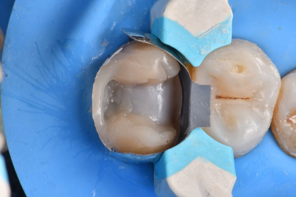 Direct Complex Crown reconstruction in composite resin
