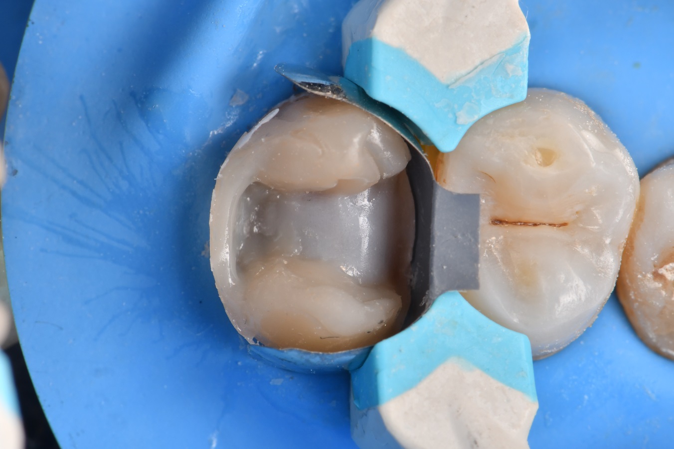 Direct Complex Crown reconstruction in composite resin