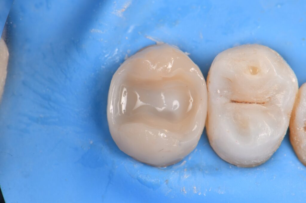 Direct Complex Crown reconstruction in composite resin