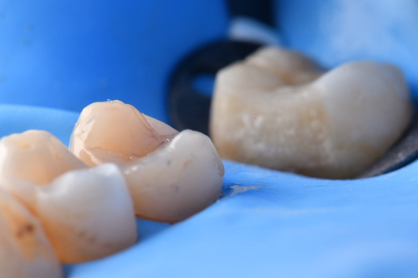 Direct Complex Crown reconstruction in composite resin