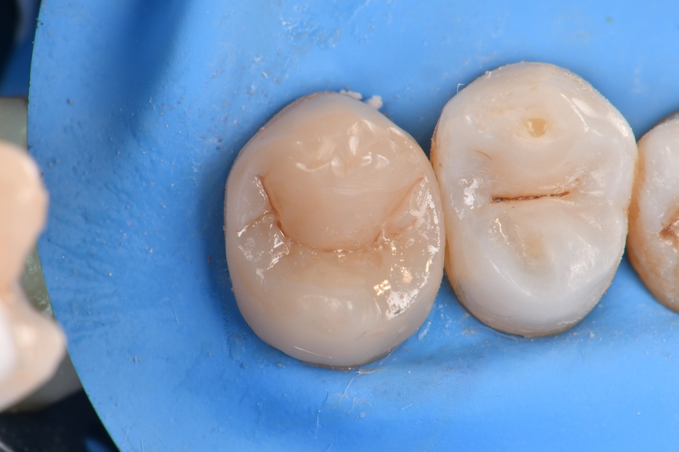 Direct Complex Crown reconstruction in composite resin