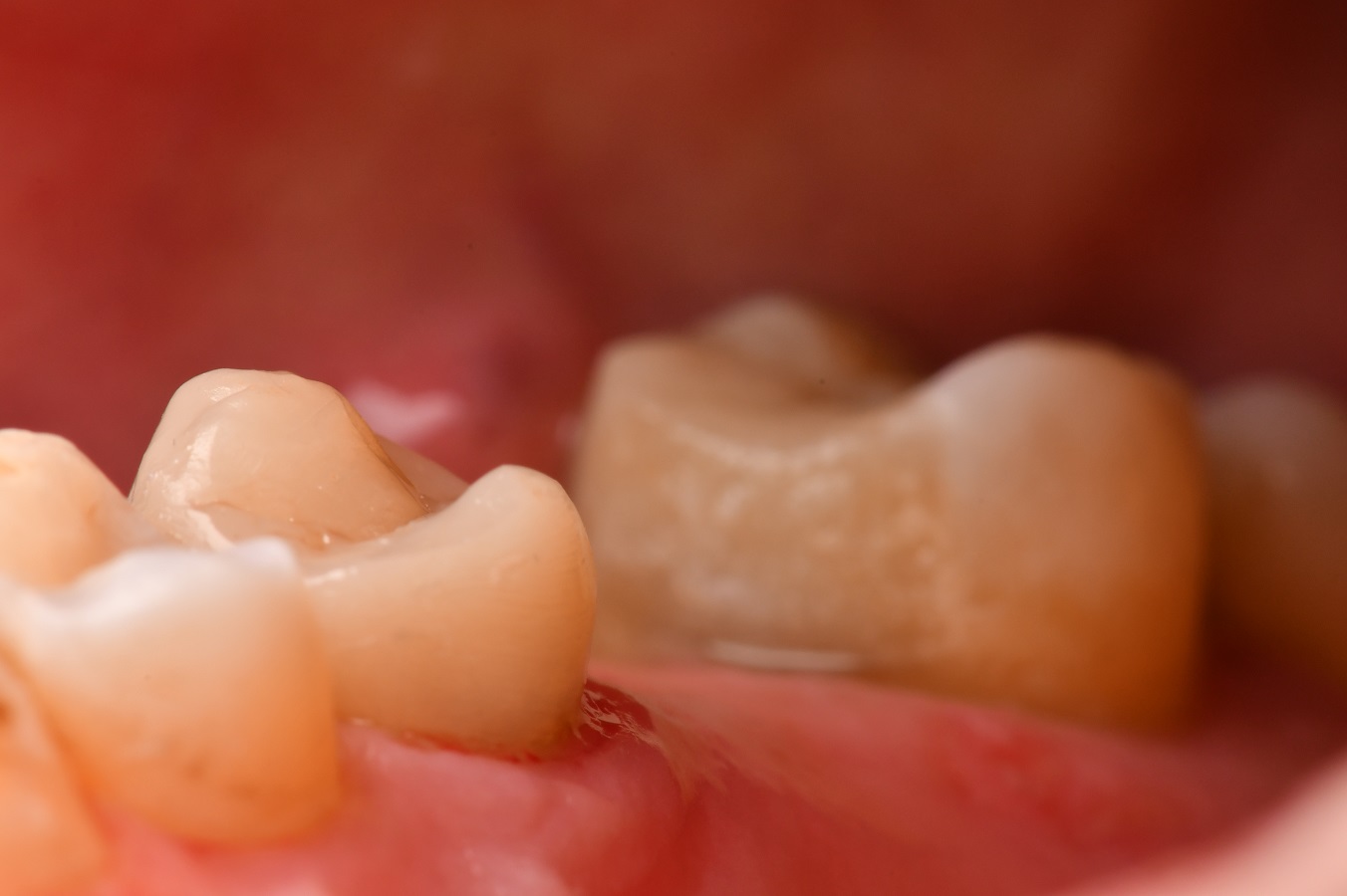 Direct Complex Crown reconstruction in composite resin