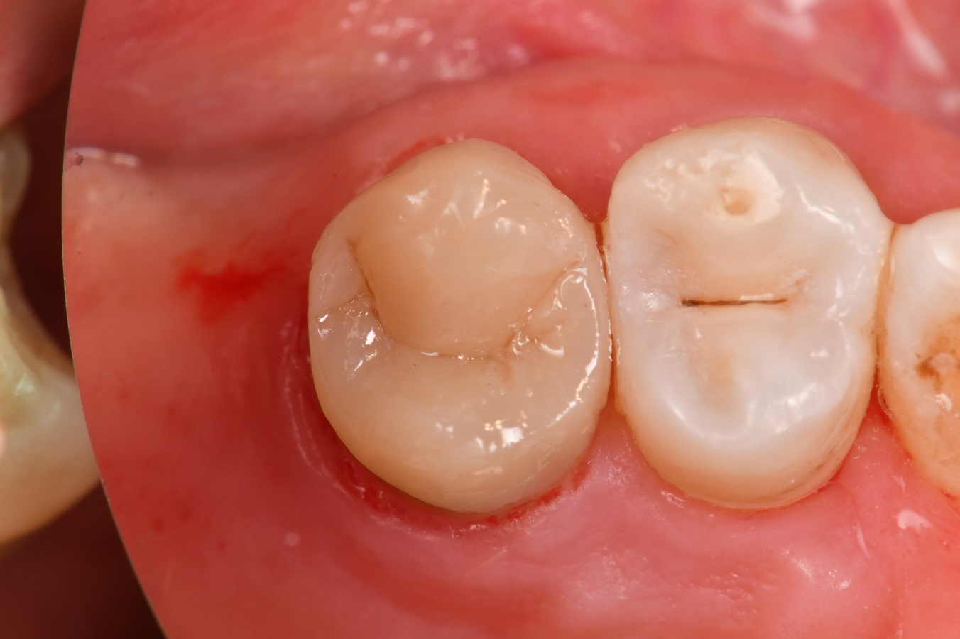 Direct Complex Crown reconstruction in composite resin