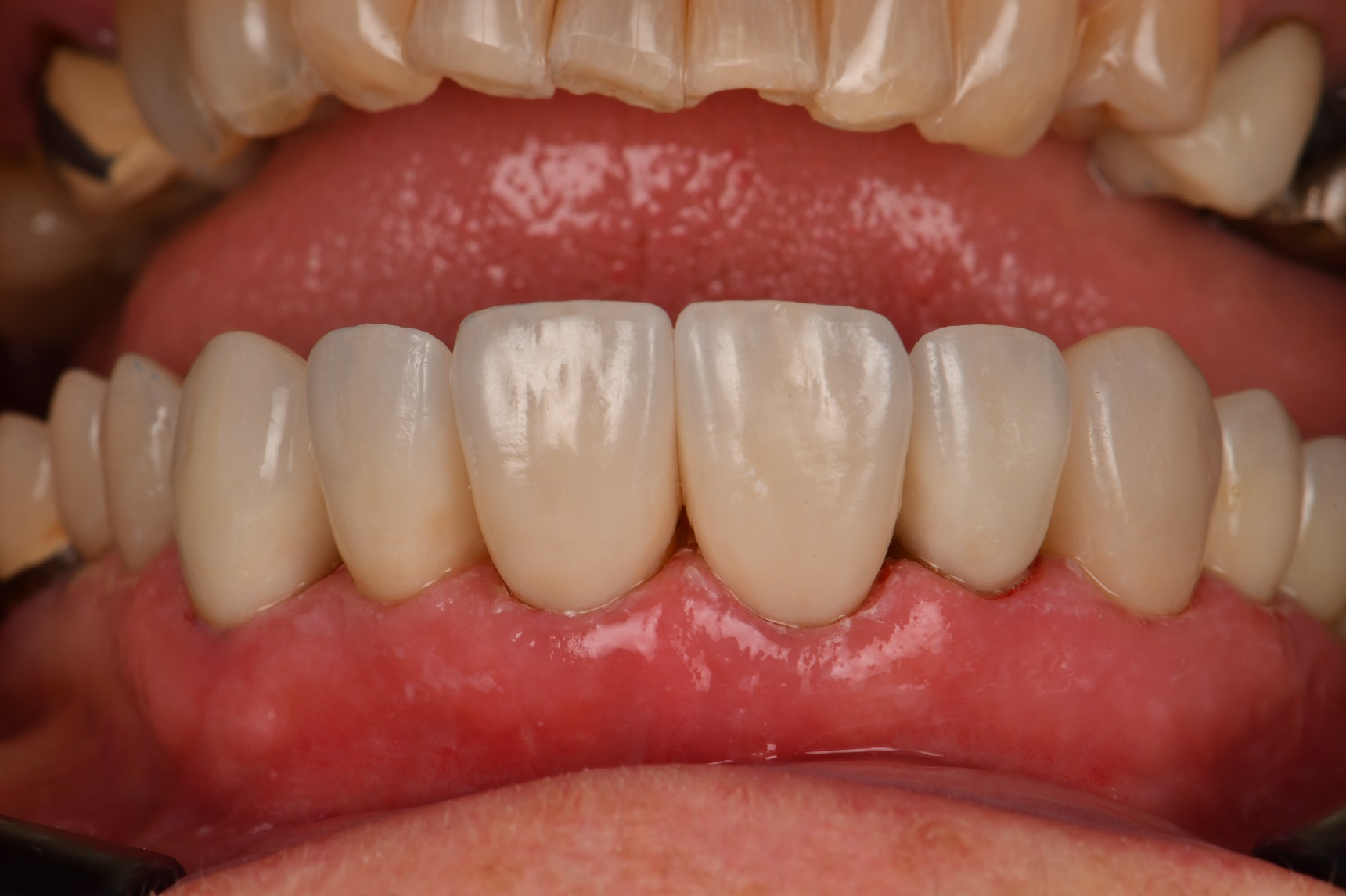 Redesign of a Smile using Porcelain and Zirconia Restorations