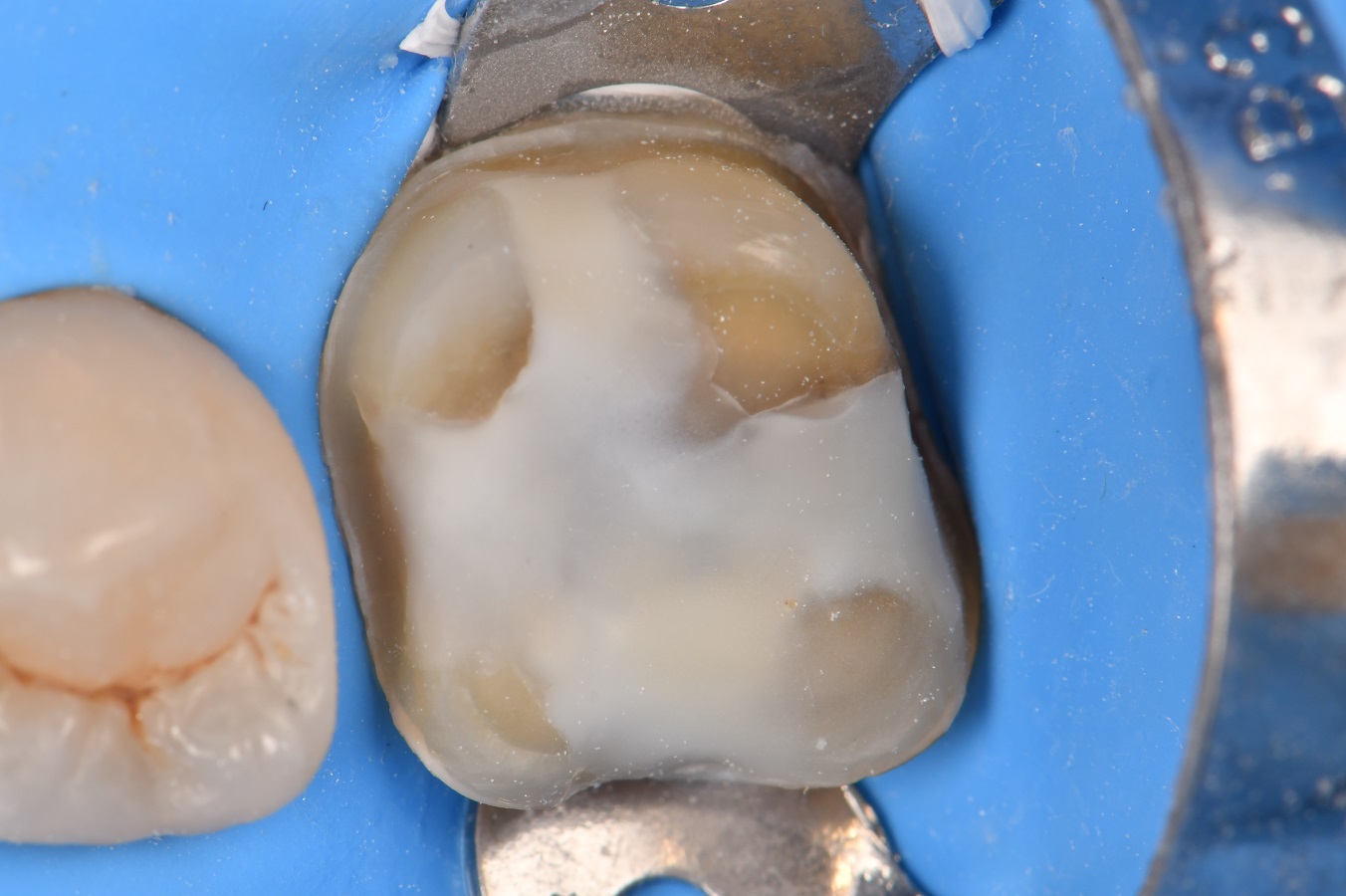 Chasing Cracks in Amalgam-filled teeth