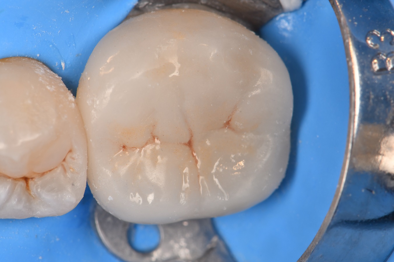 Chasing Cracks in Amalgam-filled teeth