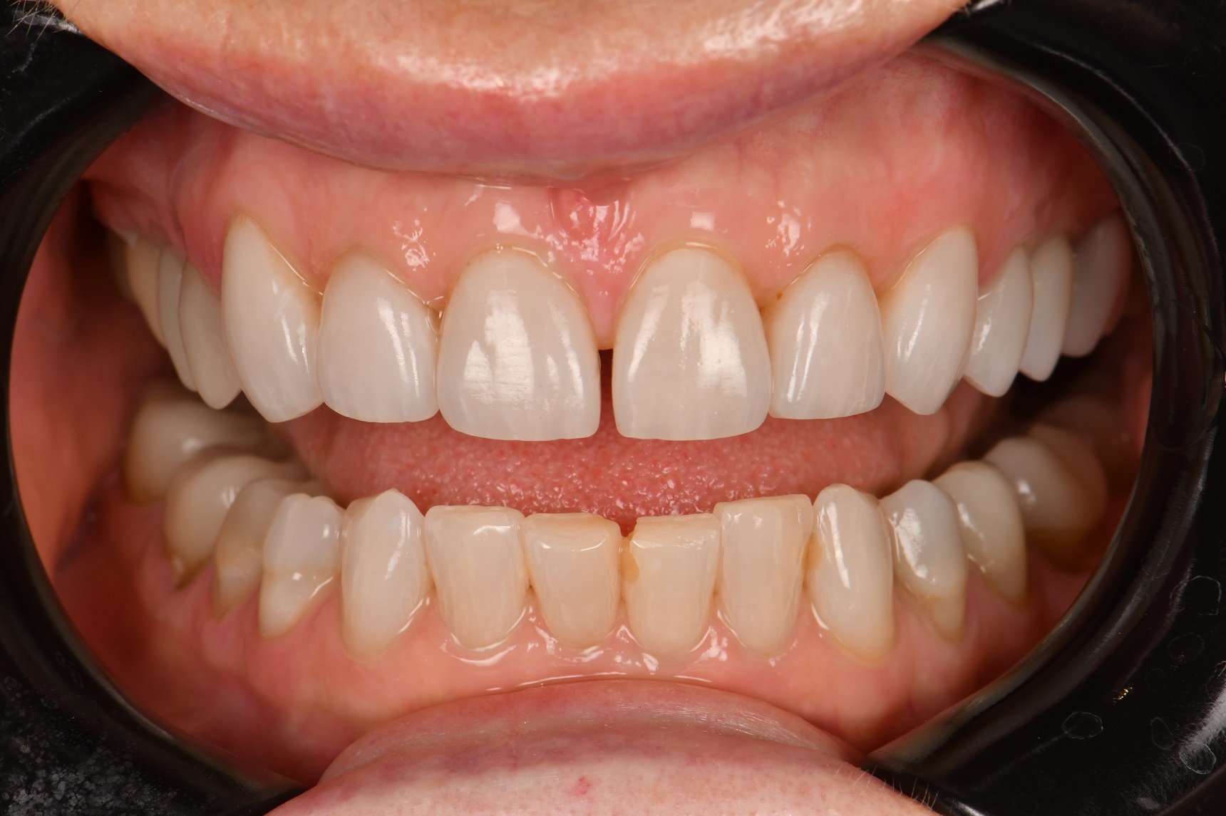 Veneer margin design and position | Duchenne smile