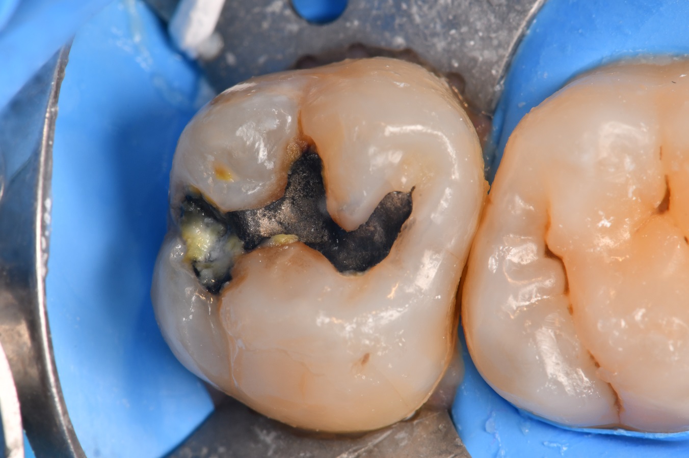 Poisson Effect and Peripheral Rim Fractures