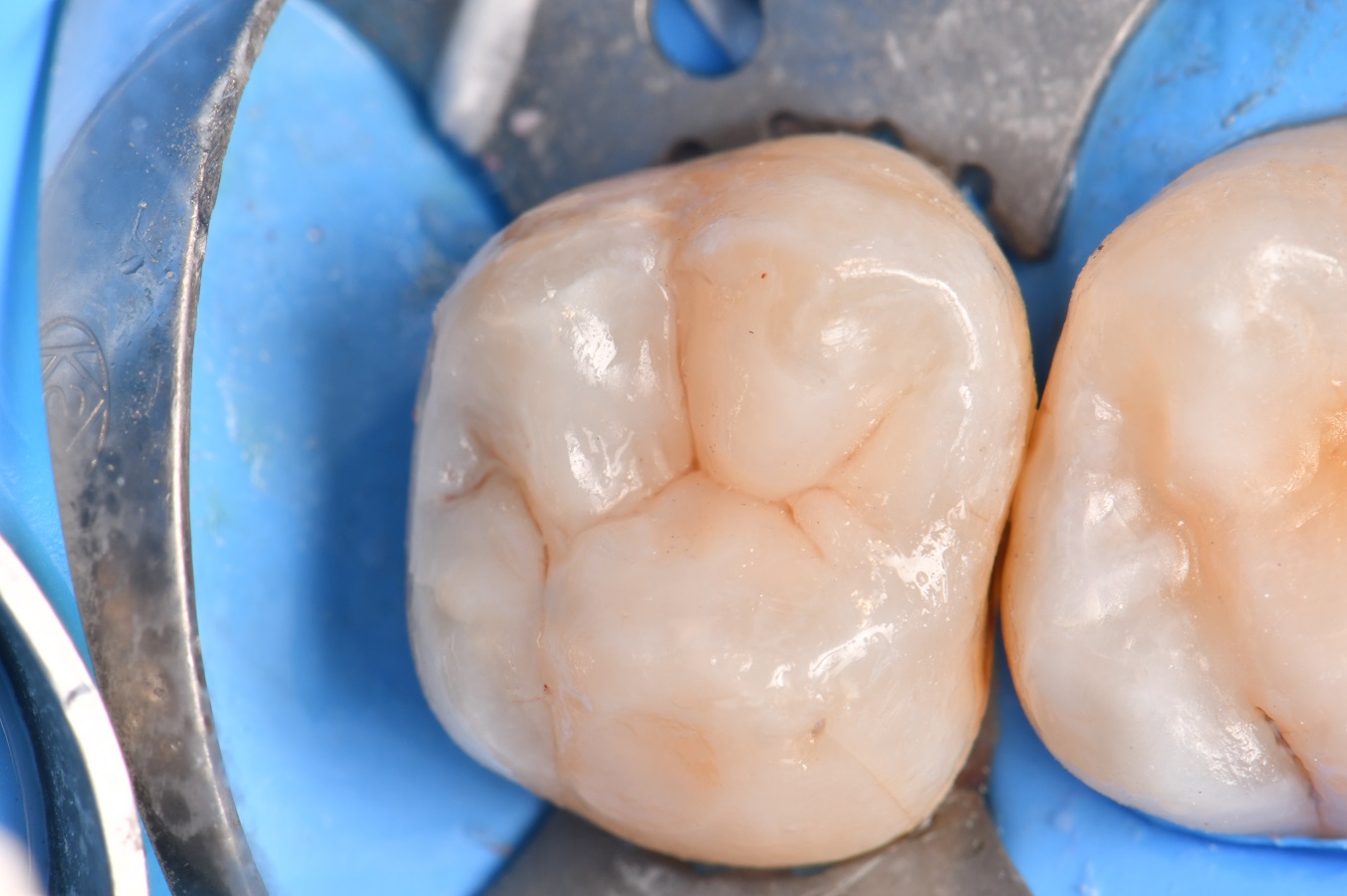 Poisson Effect and Peripheral Rim Fractures