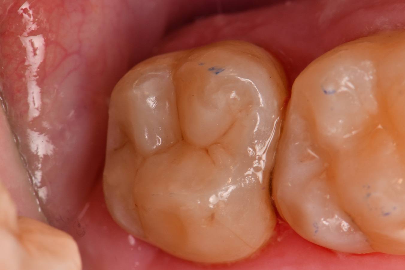 Poisson Effect and Peripheral Rim Fractures