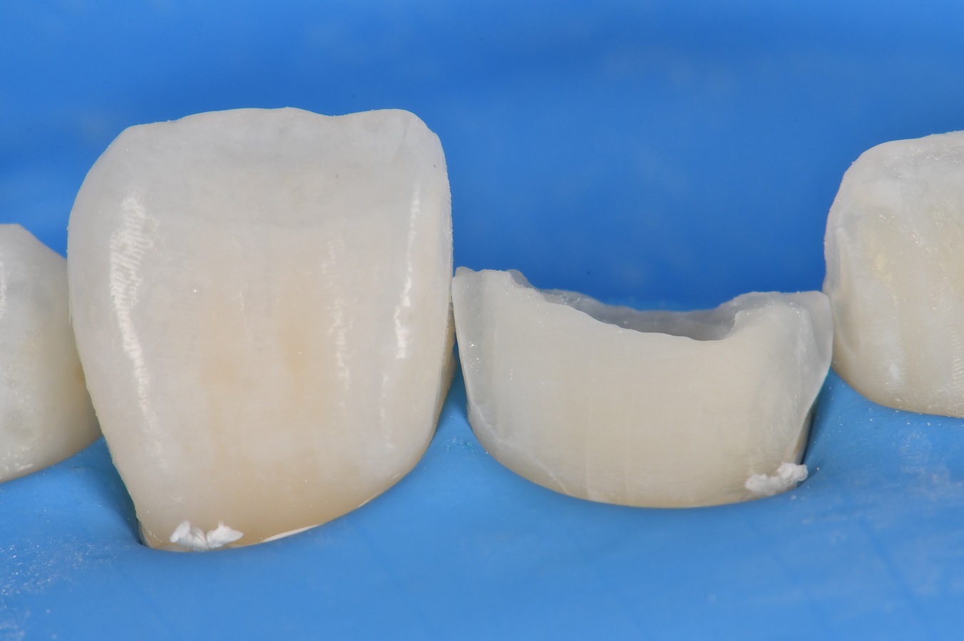 Multiaxial composite resin incisor reconstruction
