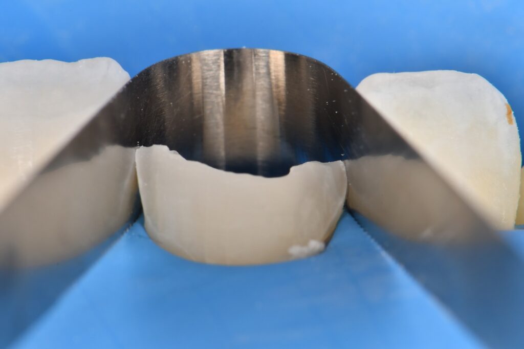 Multiaxial composite resin incisor reconstruction