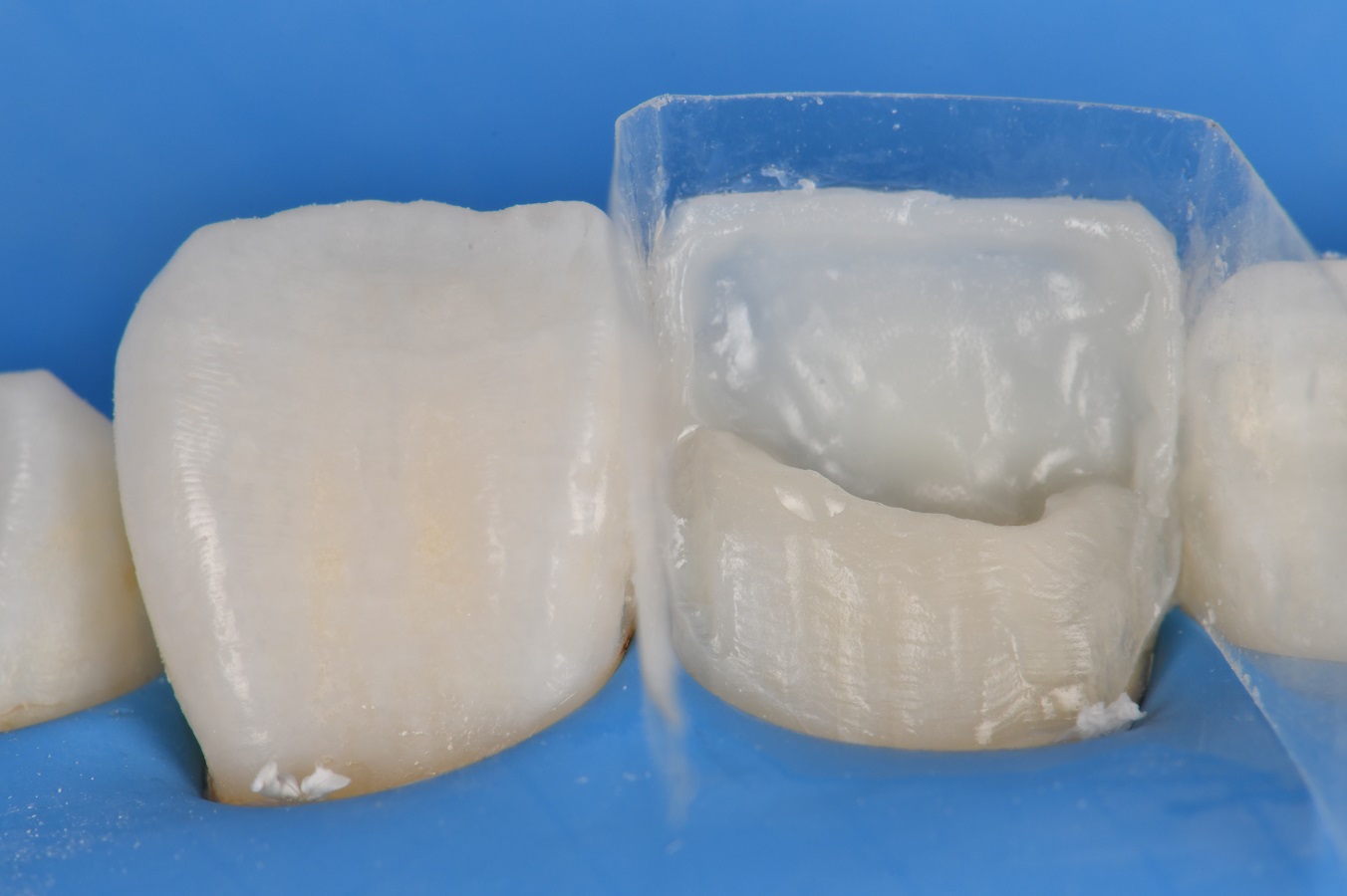 Multiaxial composite resin incisor reconstruction