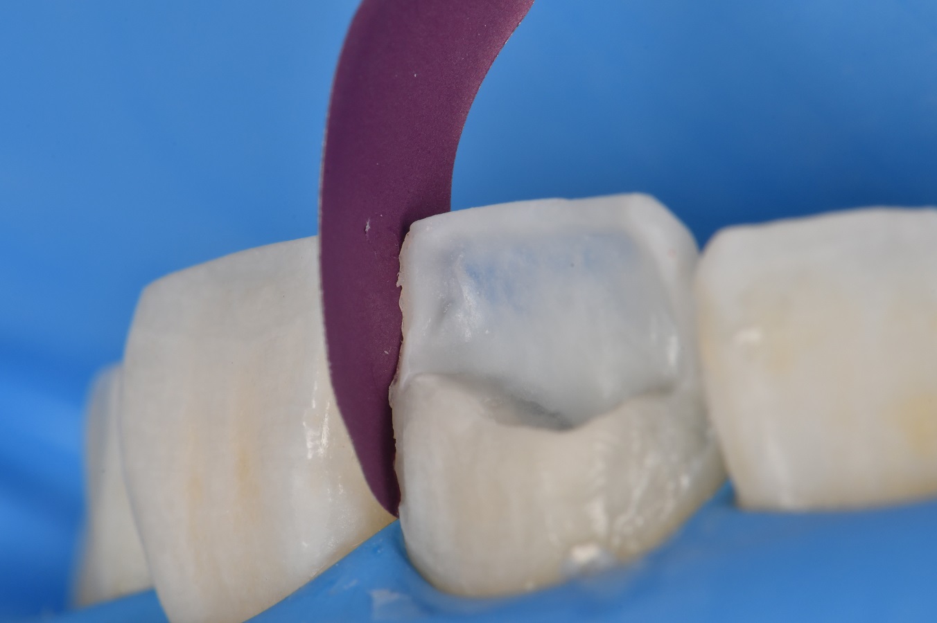 Multiaxial composite resin incisor reconstruction