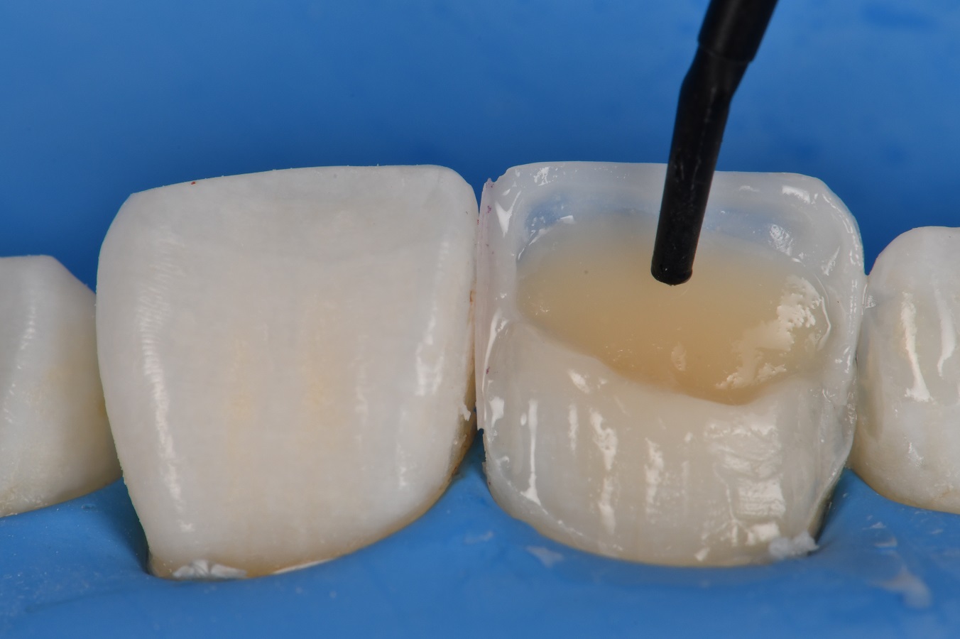Multiaxial composite resin incisor reconstruction