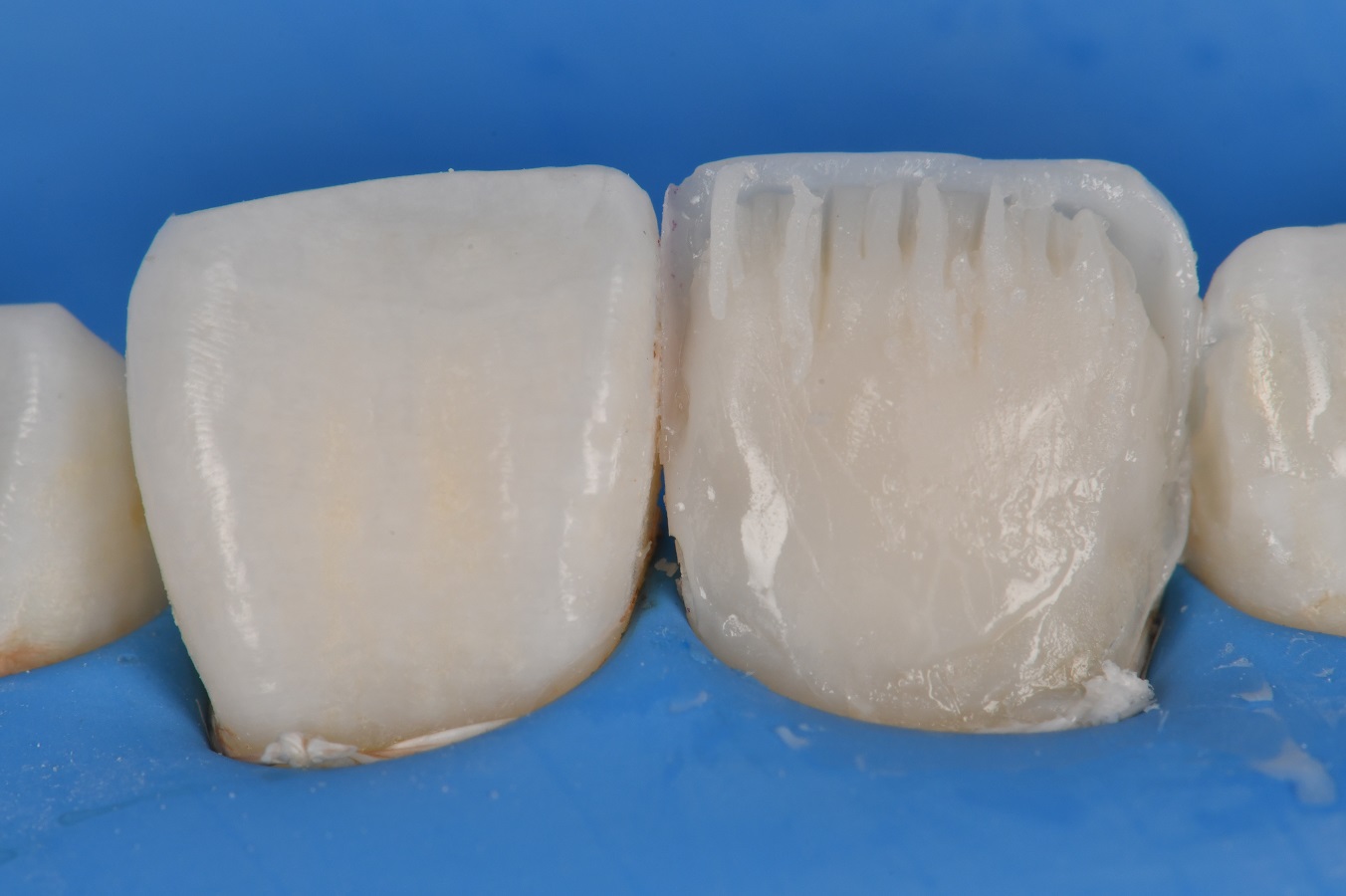 Multiaxial composite resin incisor reconstruction