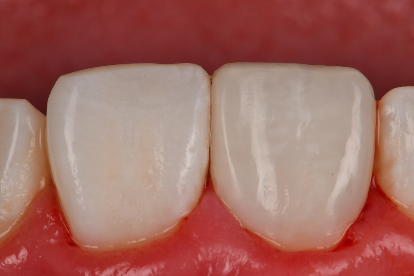 Multiaxial composite resin incisor reconstruction