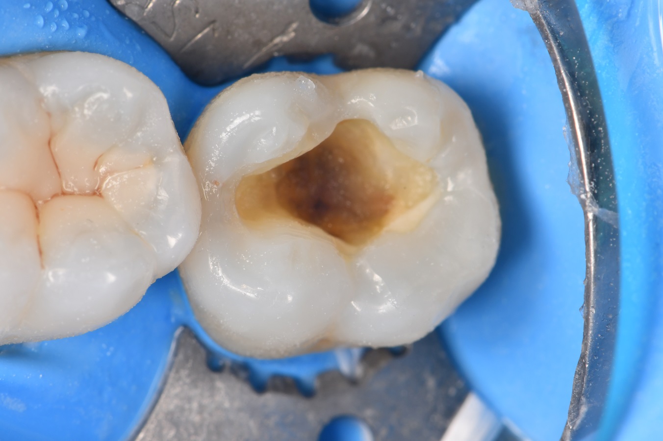 Composite Layering Protocol for Lower Second Molar