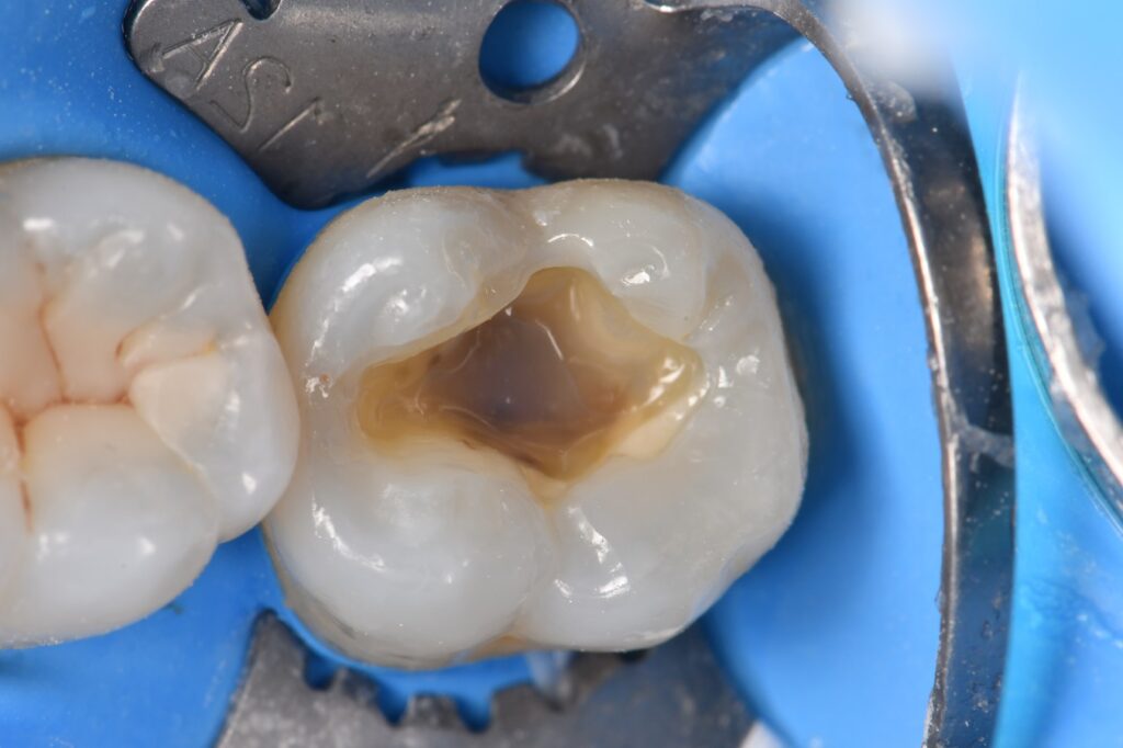 Composite Layering Protocol for Lower Second Molar